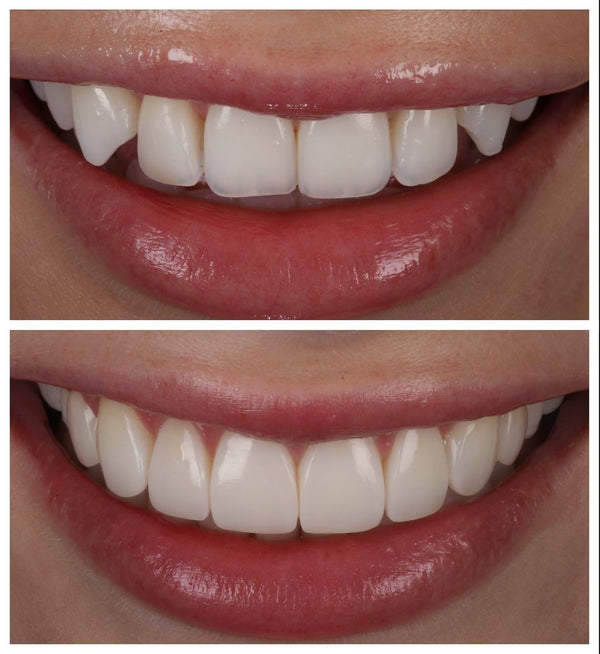 FREEHAND & INJECTABLE COMPOSITE VENEERS with Dr Khalil & Dr Andrew ...